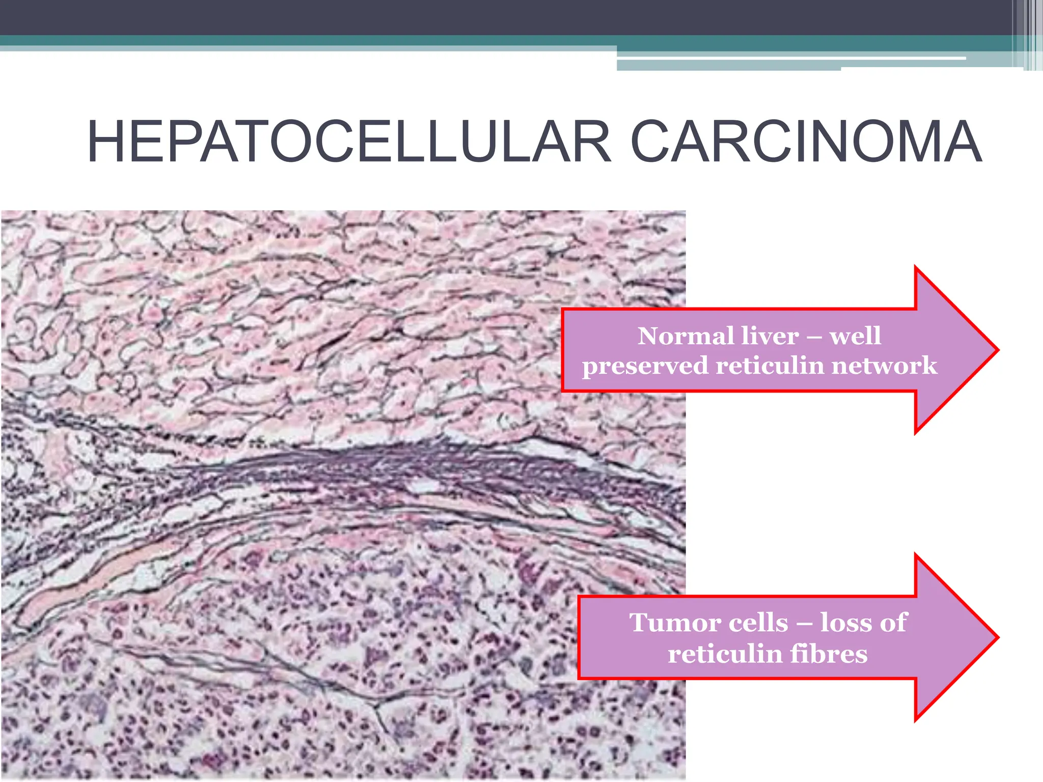RETICULIN STAIN SEMINAR 24.5.pptx