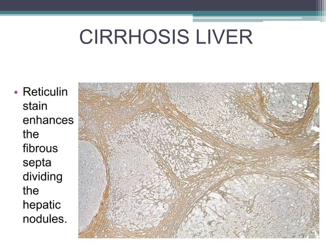RETICULIN STAIN SEMINAR 24.5.pptx