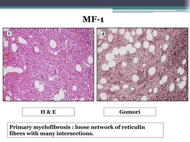 RETICULIN STAIN SEMINAR 24.5.pptx