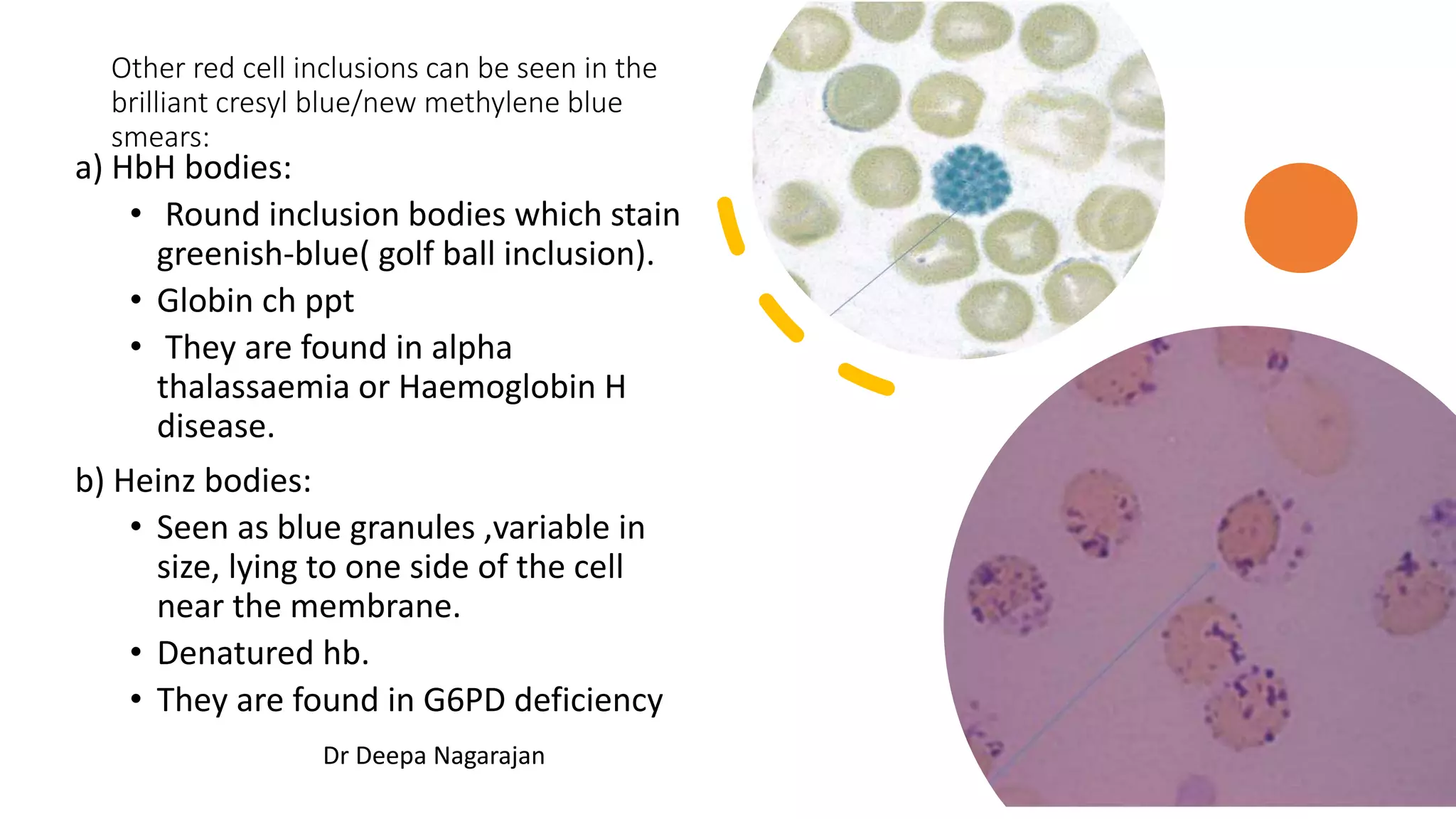 Other tests in hemolytic anaemia workup | PPTX