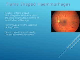 Flame Shaped Hemorrhages