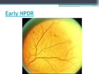 Diabetic Retinopathy | PPT