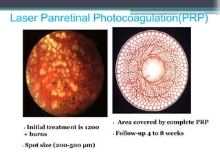 Diabetic Retinopathy | PPT