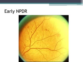 Retina 1 anatomy and diabetic retinopathy d r.k.n.jha-26.05.16