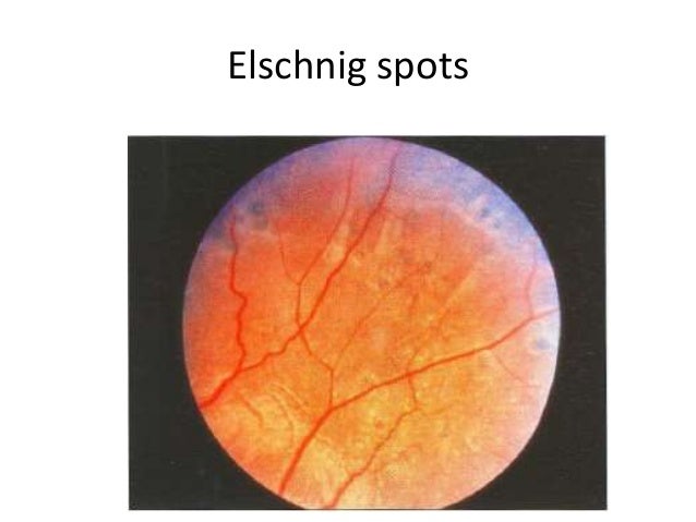 Retina 2 hypertensive changes crvo crao dr.k.n.jha -01.06.16