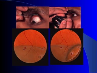 Retina 5 retinal detachment 09.06.16 - dr.k.n.jha