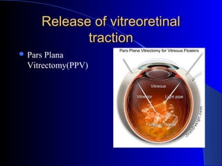 Retina 5 retinal detachment 09.06.16 - dr.k.n.jha