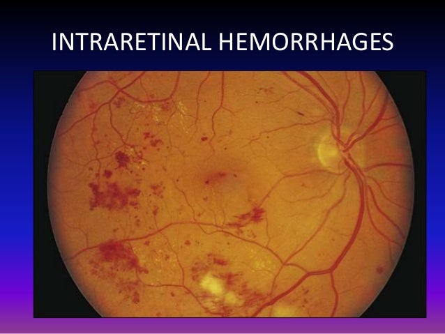Diabetic Retinopathy