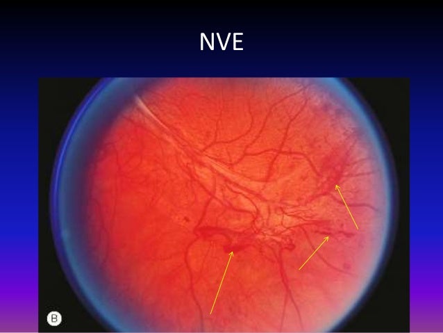 Diabetic Retinopathy
