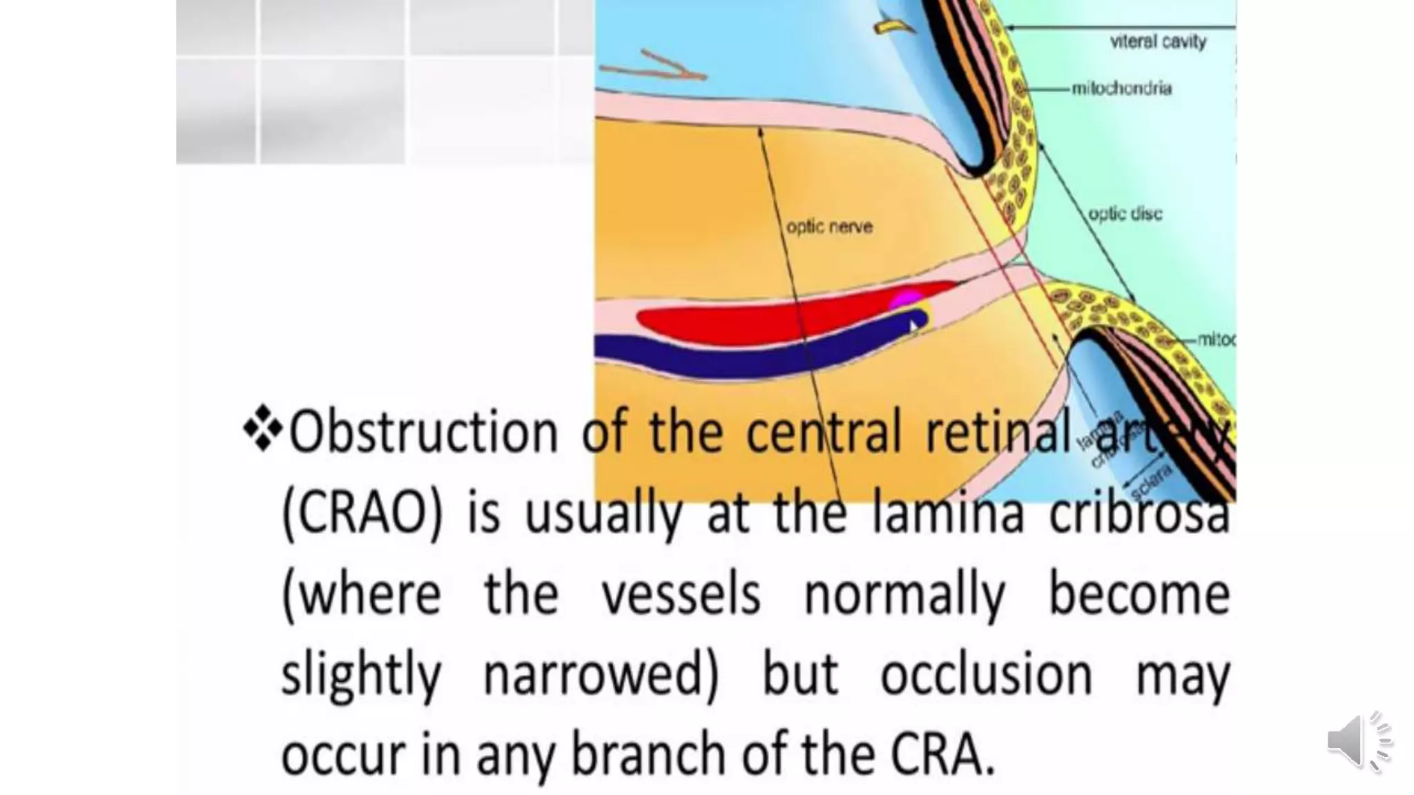 Retina Central Retinal Artery Occlusion | PPTX
