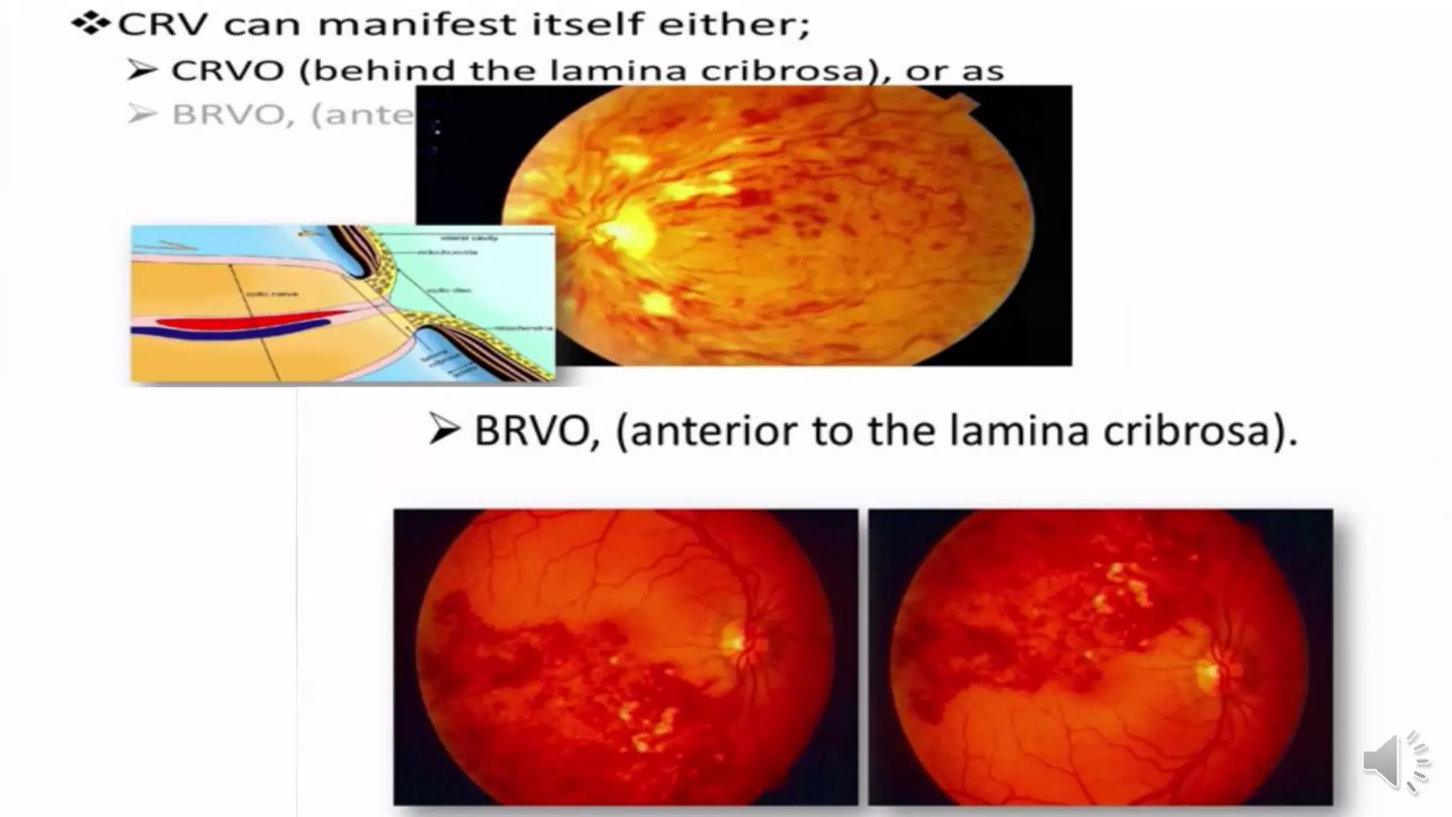 Retina Central Retinal Vein Occlusion | PPTX