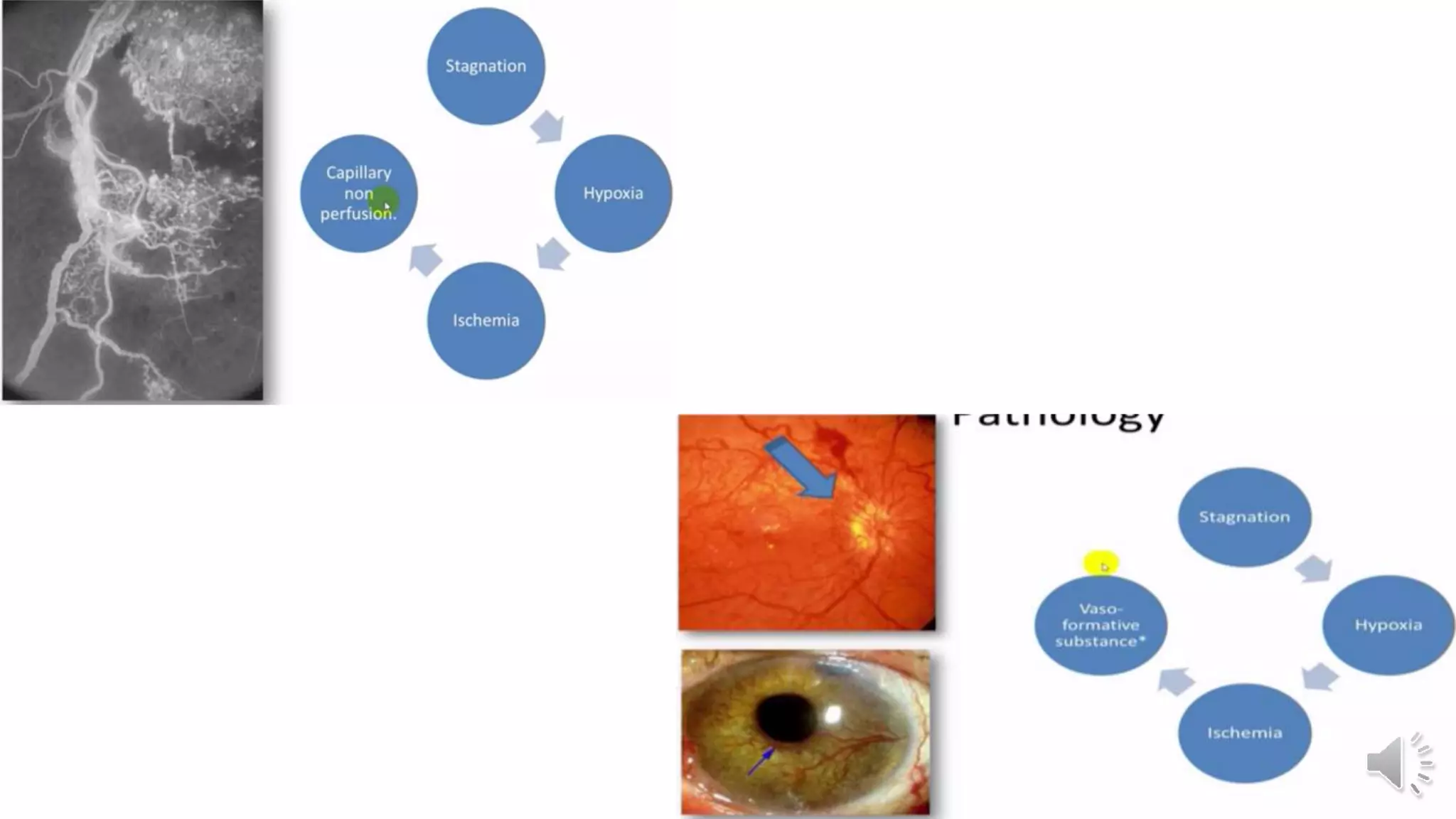 Retina Central Retinal Vein Occlusion | PPT