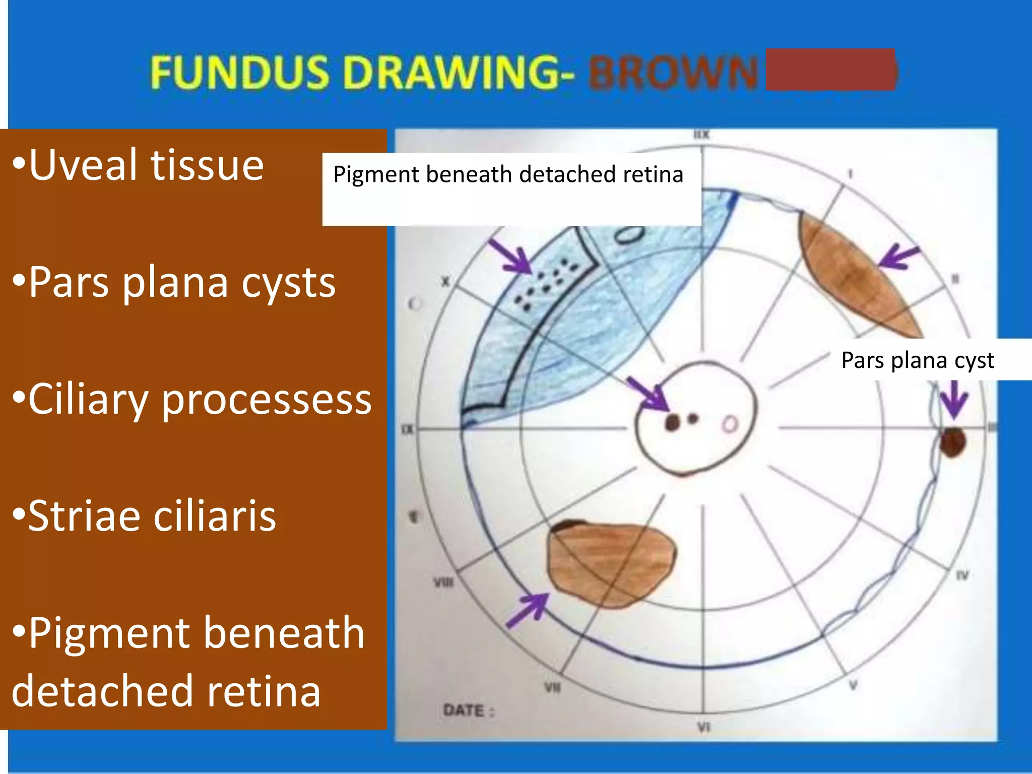 Retina drwaing | PPTX