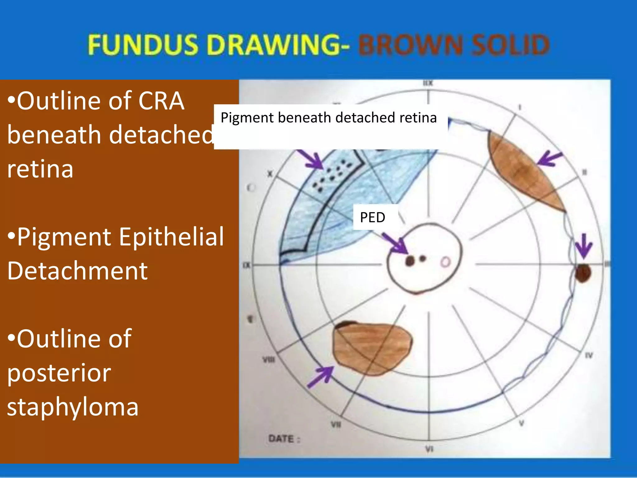 Retina drwaing | PPTX