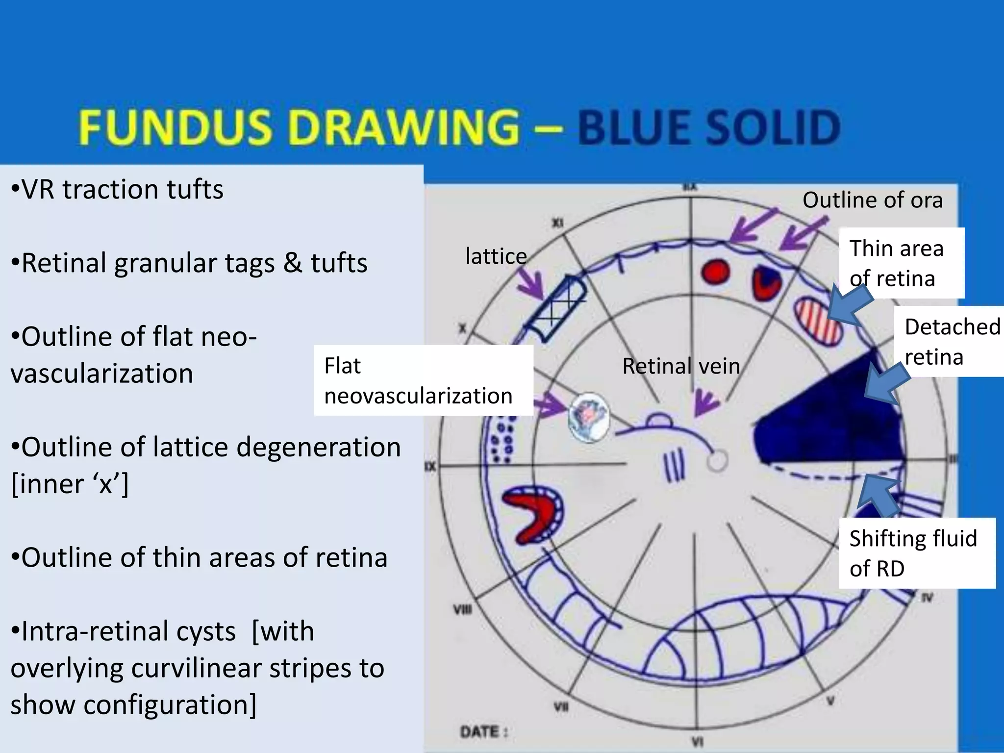 Retina drwaing | PPTX