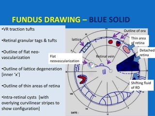 Retina drwaing | PPTX
