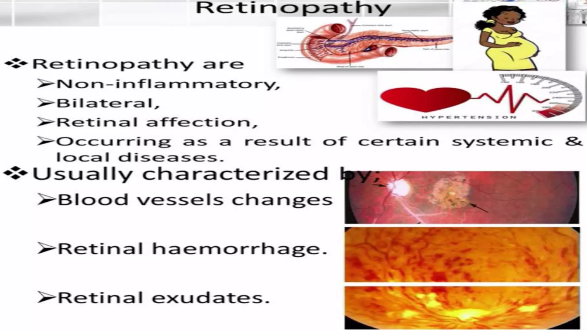 Retina hypertensive retinopathy | PPT
