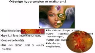 Retina hypertensive retinopathy | PPT