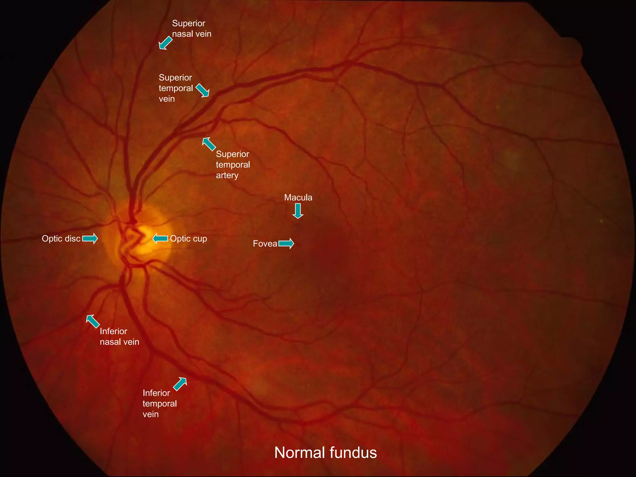 Retinal Conditions | PPS | Eye and Vision Conditions | Diseases and ...