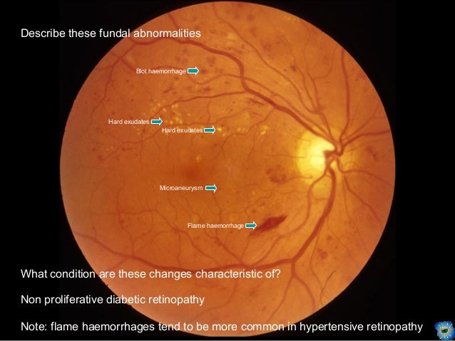 Retinal Conditions