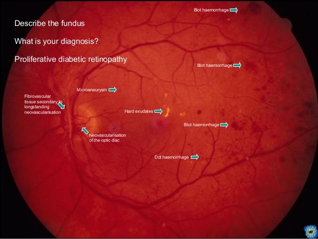 Retinal Conditions