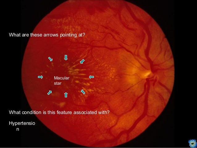 Retinal Conditions