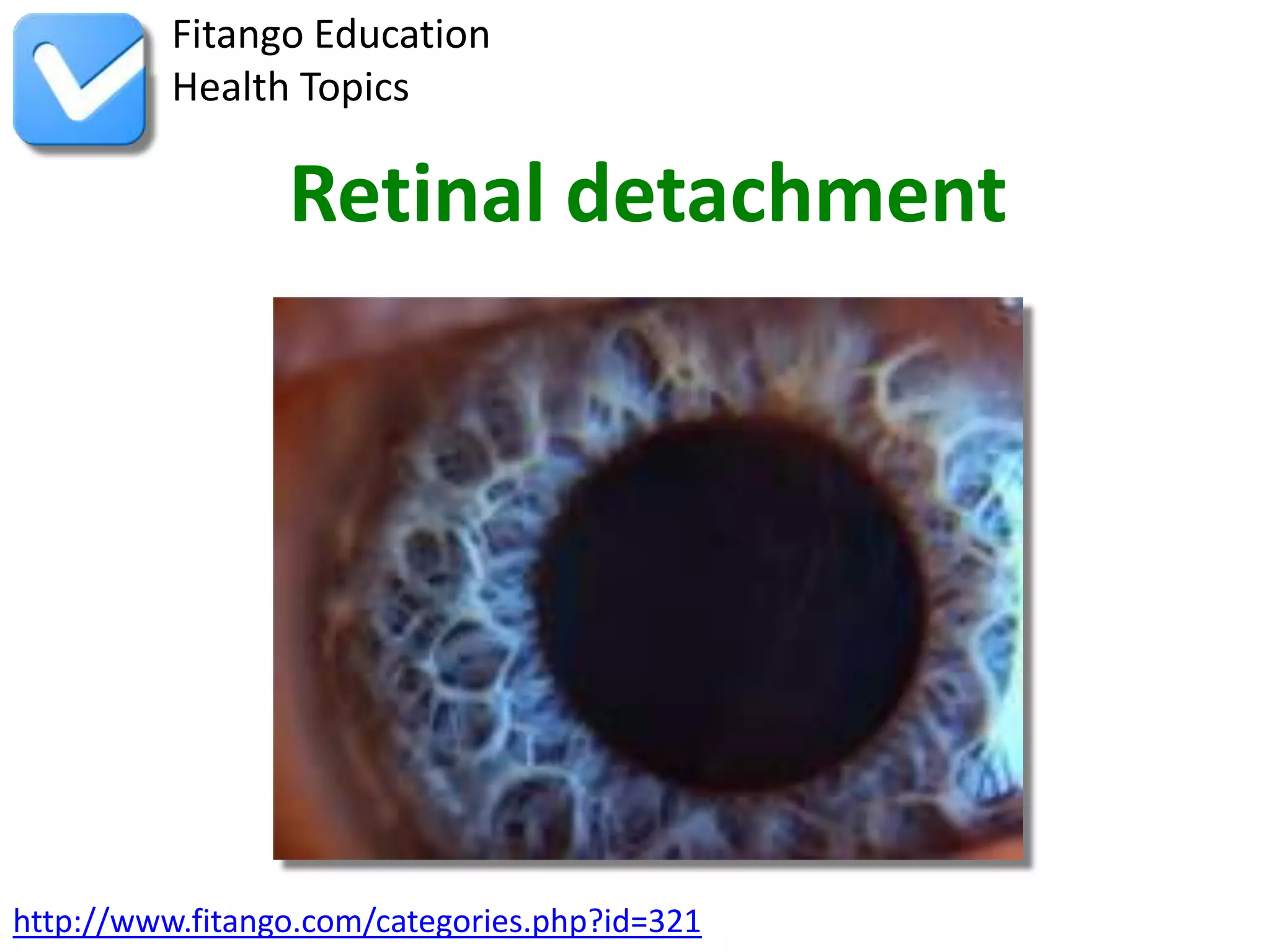 Retinal detachment | PPTX