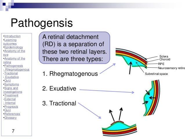 Retinal detachment