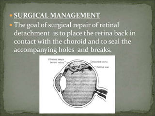 RETINAL%20DETACHMENT.pptx | Eye and Vision Conditions | Diseases and ...