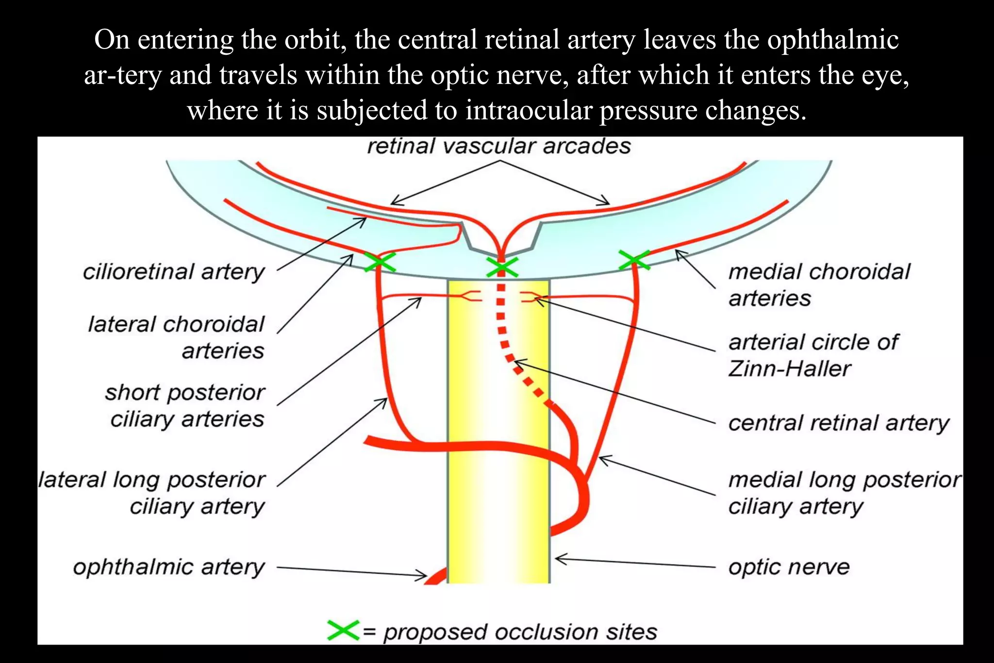 RETINAL ARTERY OCCLUSION , DR SAQUIB | PDF