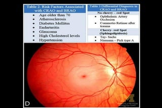 RETINAL ARTERY OCCLUSION , DR SAQUIB | PDF