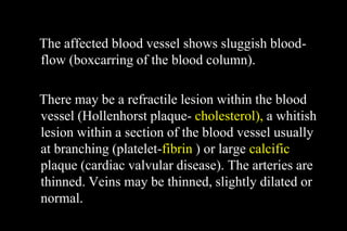 RETINAL ARTERY OCCLUSION , DR SAQUIB | PDF
