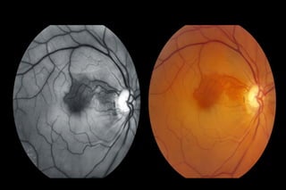 RETINAL ARTERY OCCLUSION , DR SAQUIB | PDF