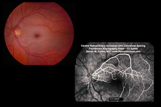 RETINAL ARTERY OCCLUSION , DR SAQUIB | PDF