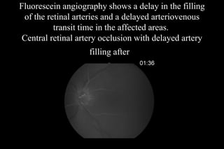 RETINAL ARTERY OCCLUSION , DR SAQUIB | PDF