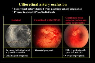 RETINAL ARTERY OCCLUSION , DR SAQUIB | PDF