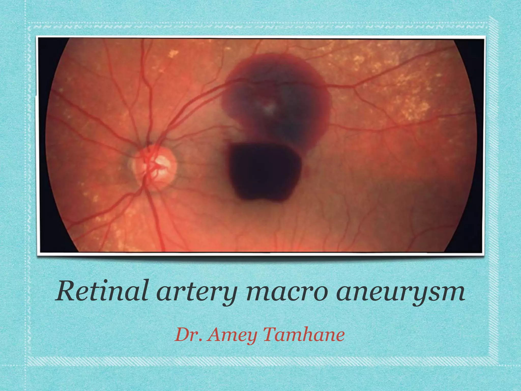 Retinal Artery Macroaneurysm.pptx