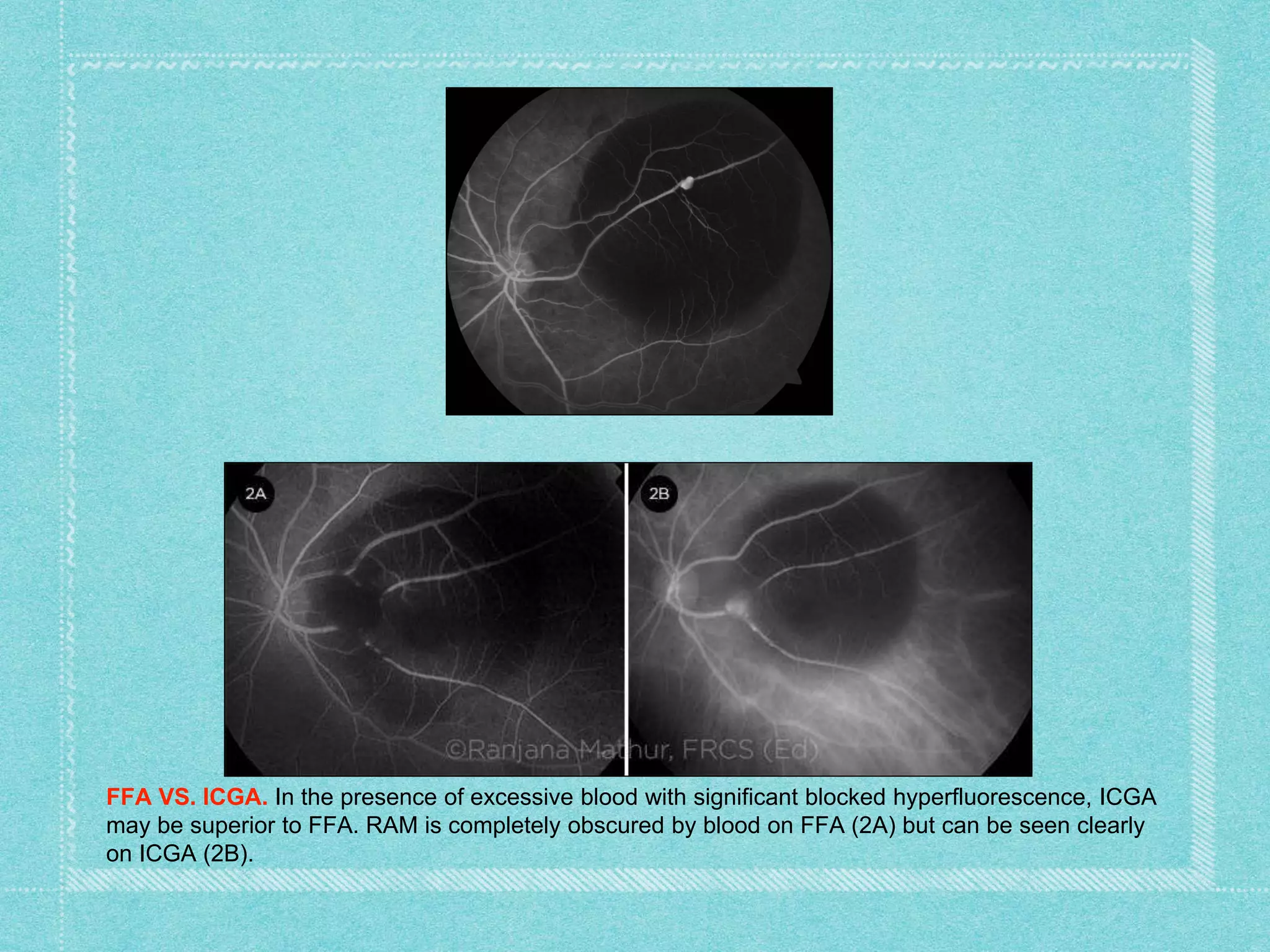 Retinal Artery Macroaneurysm.pptx