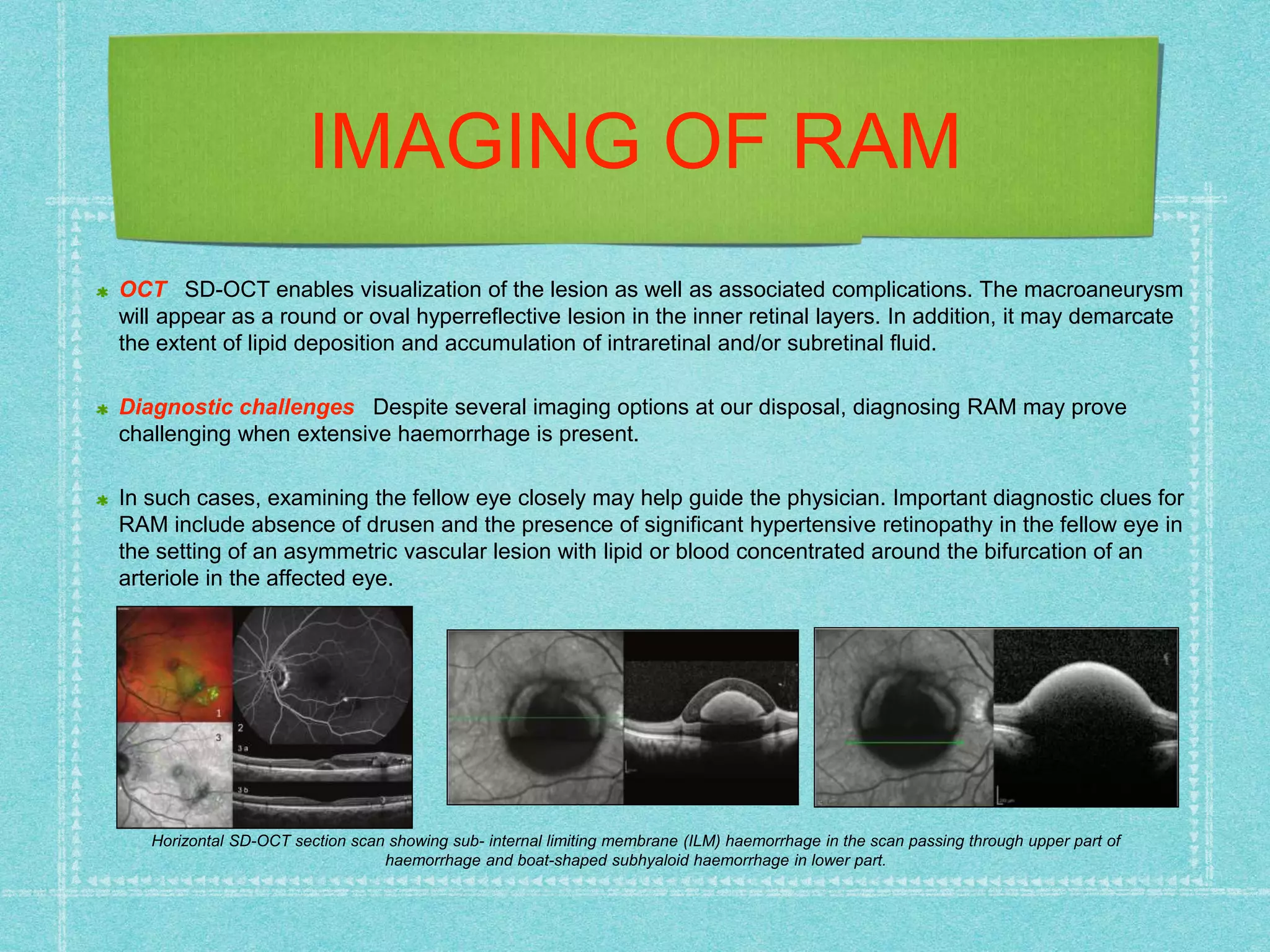 Retinal Artery Macroaneurysm.pptx