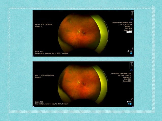 Retinal Artery Macroaneurysm.pptx | Eye and Vision Conditions ...
