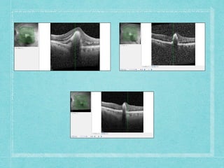 Retinal Artery Macroaneurysm.pptx