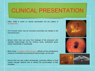 Retinal Artery Macroaneurysm.pptx