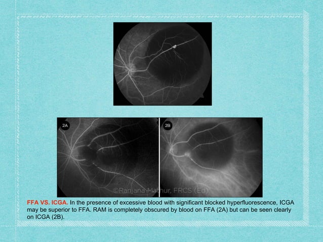 Retinal Artery Macroaneurysm.pptx | Eye and Vision Conditions ...