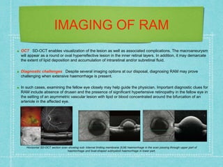 Retinal Artery Macroaneurysm.pptx