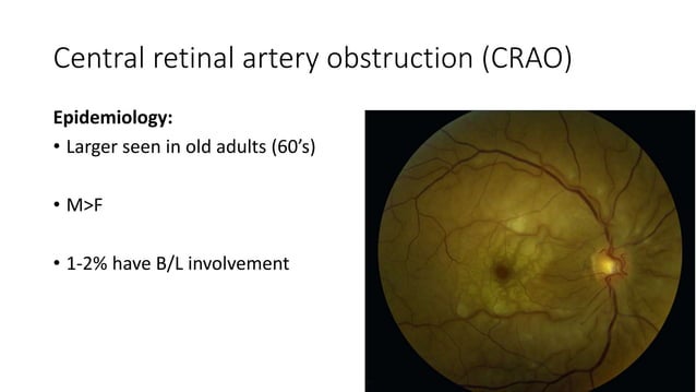 Retinal artery occlusion | PPTX