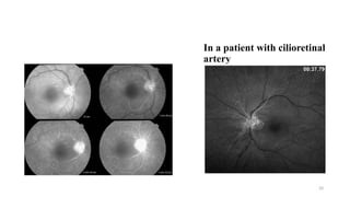 Retinal artery occlusion ppt............. | PPTX