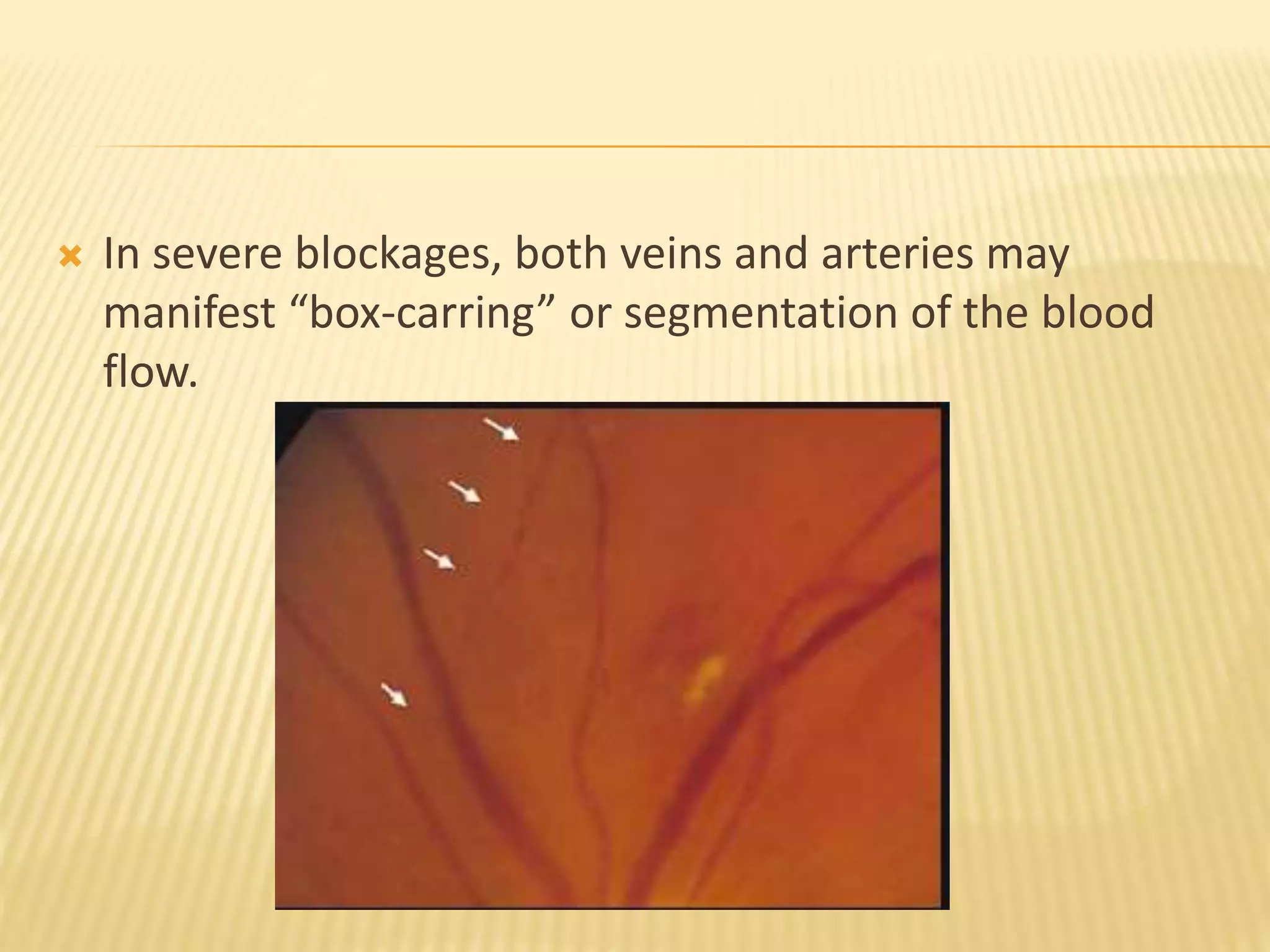 Retinal artery occlusions | PPTX
