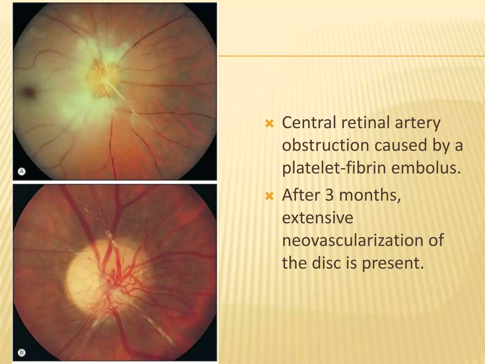 Retinal artery occlusions | PPTX