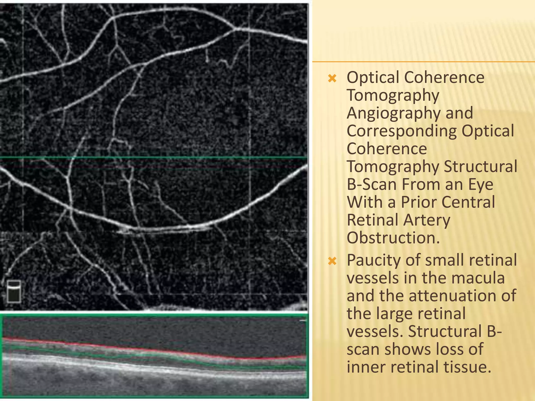 Retinal artery occlusions | PPTX
