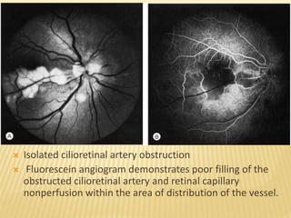 Retinal artery occlusions | PPTX